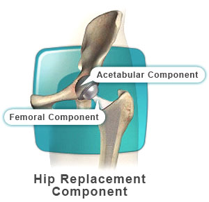 Hip Replacement Surgery :: South Arkansas Orthopaedics & Sports Medicine